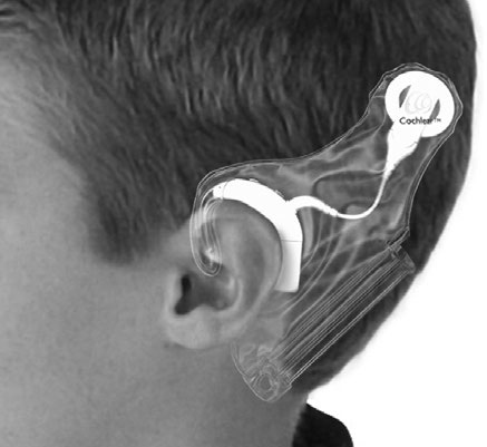 Nucleus® Aqua Accessory | Cochlear Denmark